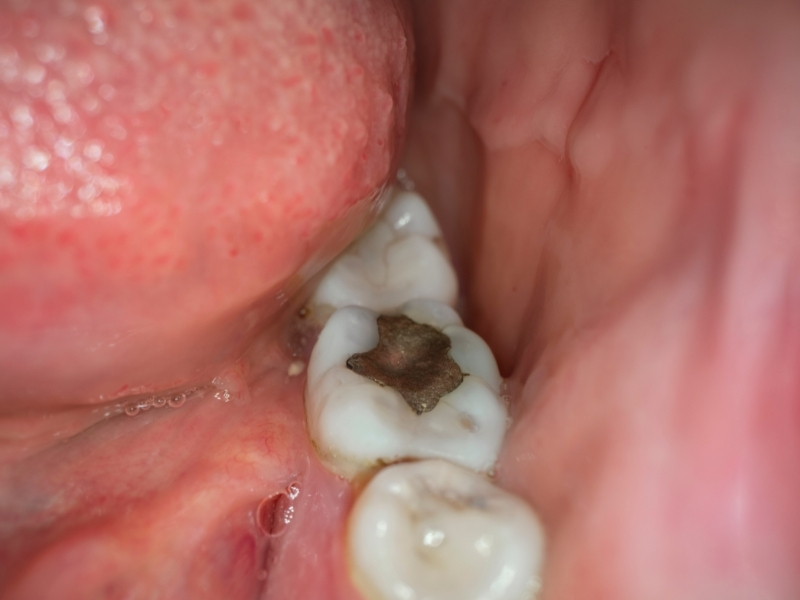 ¿Qué son los empastes de amalgama dentales? | Dentista en Montilla